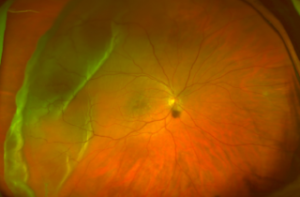 Vitreoretinal Surgery | Moorfields Eye Hospital Vitreoretinal Surgeon ...