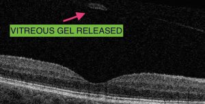 Vitreomacular Traction | Vitreomacular Traction Surgery | VMT Eye Surgery
