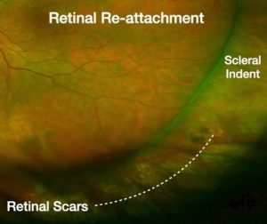 Retinal Detachment Surgery in London – Mahi Muqit