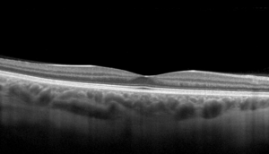 Vitreomacular Traction | Vitreomacular Traction Surgery | VMT Eye Surgery