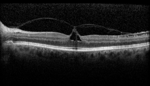 Vitreomacular Traction | Vitreomacular Traction Surgery | VMT Eye Surgery
