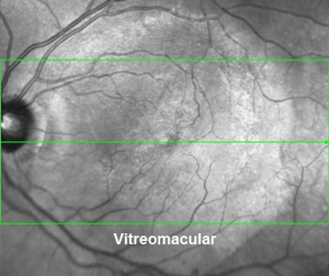 Vitreomacular Traction | Vitreomacular Traction Surgery | VMT Eye Surgery