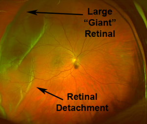 Retinal Detachment – Retina Surgeon
