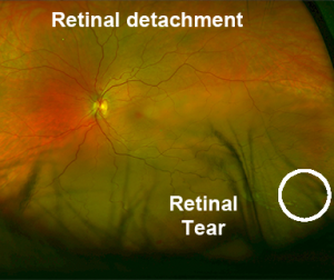Retinal Detachment Surgery in London – Mahi Muqit